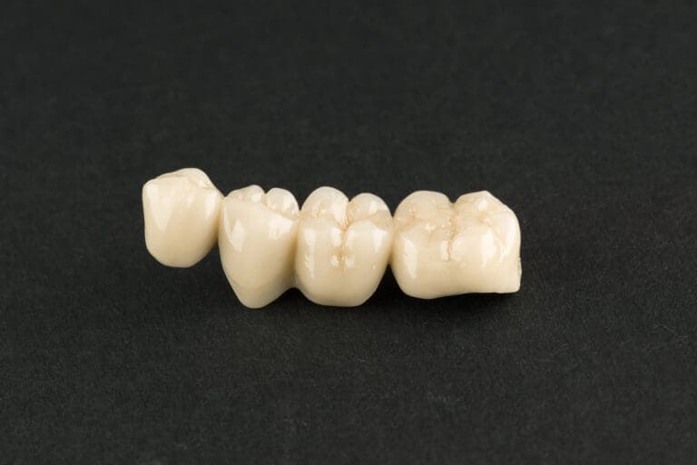 Dental Bridge vs Partial Denture: Which One is Right for You ...